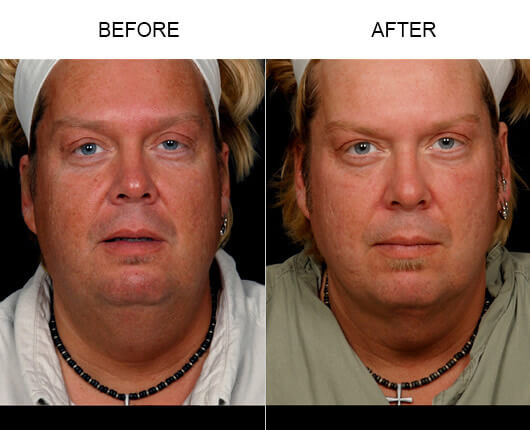 LazerLift | Orlando Laser Facelift